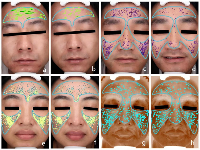 Efficacy and safety of 570/590 Nm yellow light combined with red light ...