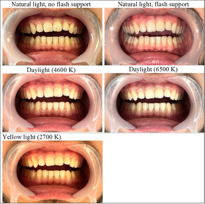 Tooth color prediction in intraoral images under different clinical ...