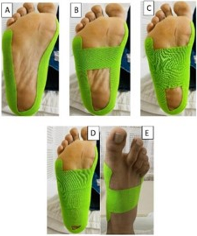 Effect of class IV LASER therapy along with Low-dye kinesio-taping ...