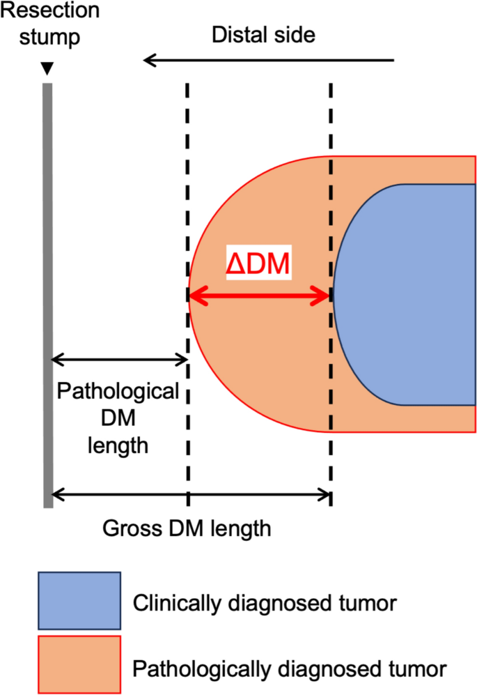 Minimum resection length to ensure a pathologically negative distal ...