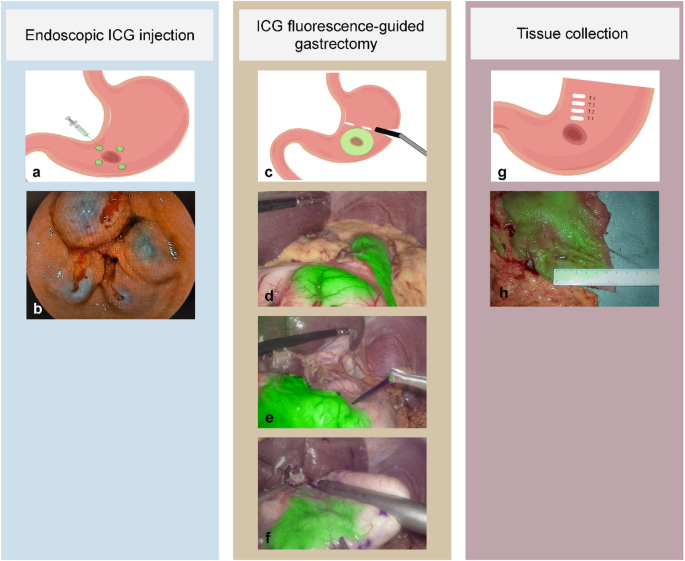 Indocyanine green fluorescence-guided proximal margin identification in ...