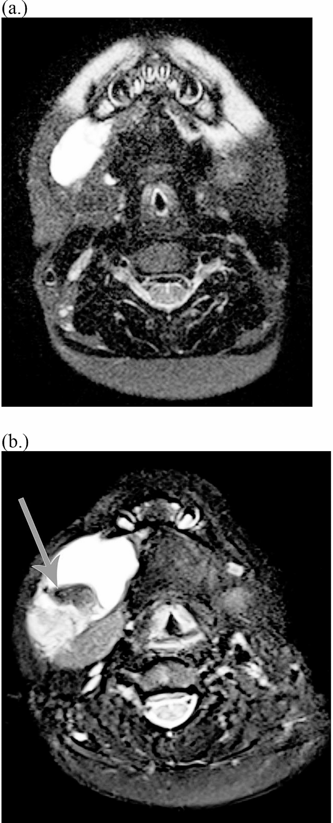 Complications of pediatric macrocystic lymphatic malformations of the ...