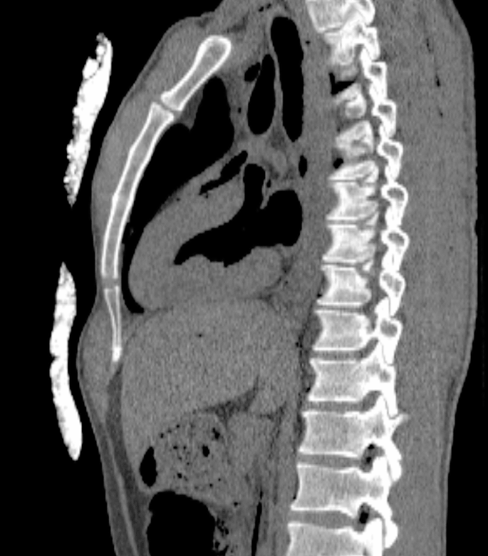 Thermal insulation does not hamper assessment of injuries in trauma CT ...