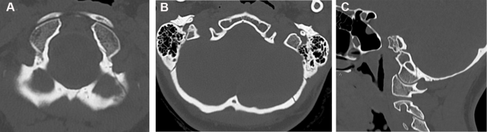 Occipital condyle fractures revisited | Emergency Radiology