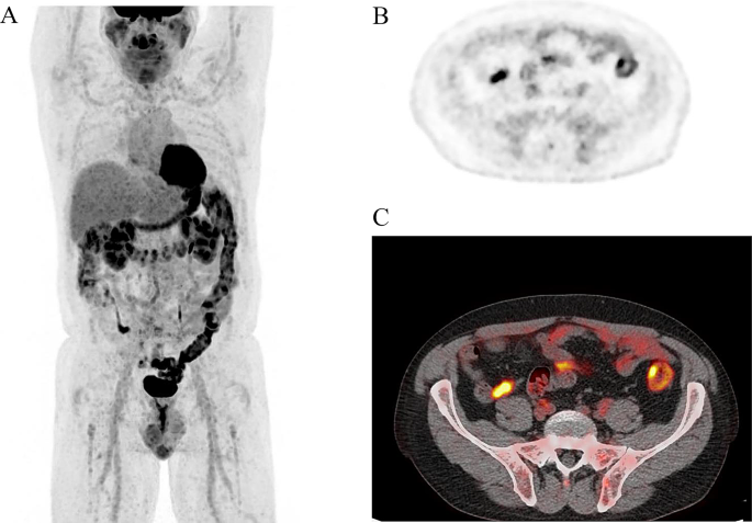 Assessing the utility of FDG PET/CT study in diagnosis of early acute ...