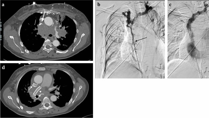 Safety and efficacy of the Abre™ venous stent in treating thoracic ...