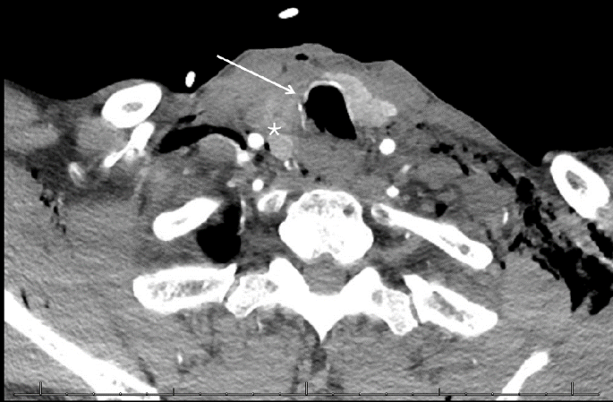 Imaging of tracheobronchial and laryngeal injuries | Emergency Radiology