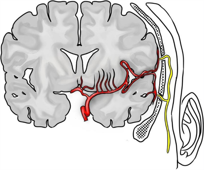 STA-MCA Double-Barrel Bypass: A Systematic Review of Technique and ...