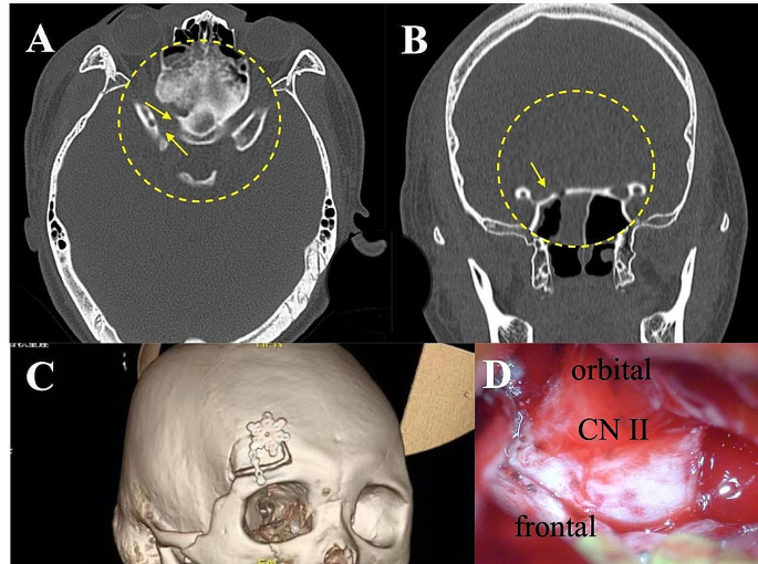 Optic nerve decompression through pterional and supraorbital approaches ...