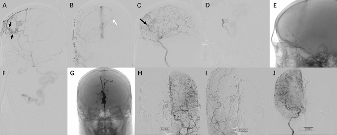 Dural arteriovenous fistulas in the falx cerebri: case series and ...