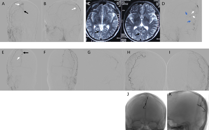 Dural arteriovenous fistulas in the falx cerebri: case series and ...