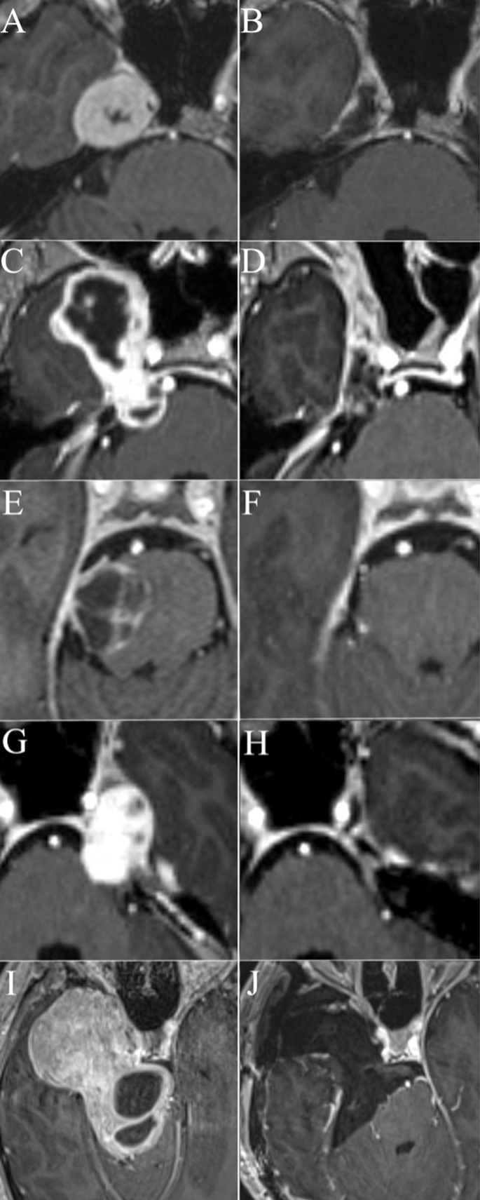 Clinical characteristics and outcomes after trigeminal schwannoma ...
