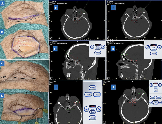 Exploring optimal microscopic keyhole access to the skull base: an ...