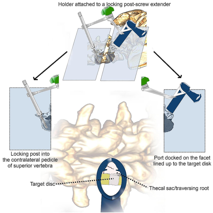 A novel endoscope-port unit for lumbar microendoscopic surgery: a ...
