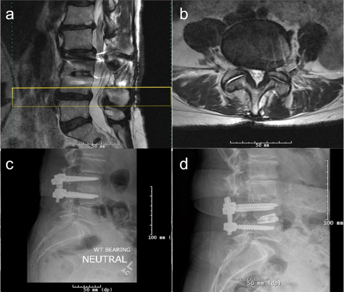 A novel endoscope-port unit for lumbar microendoscopic surgery: a ...