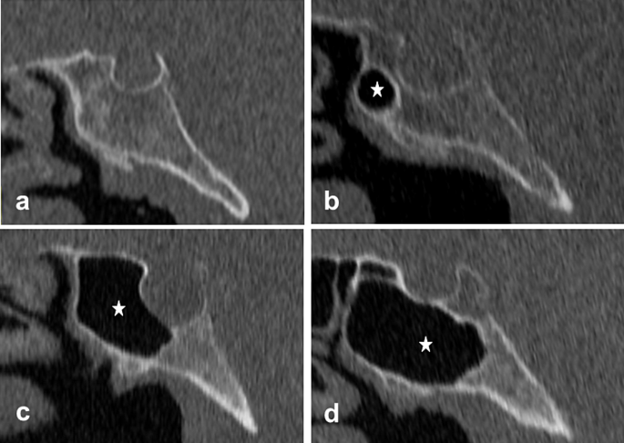 Computed tomography based evaluation of the association between ...