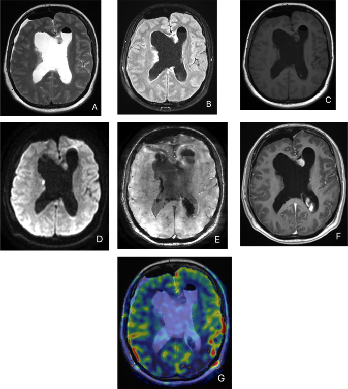 Risk factors for early intraventricular hemorrhagic complications ...