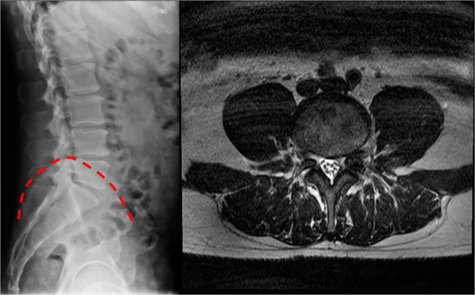 L4-L5 anatomy classification system for lateral lumbar interbody fusion ...