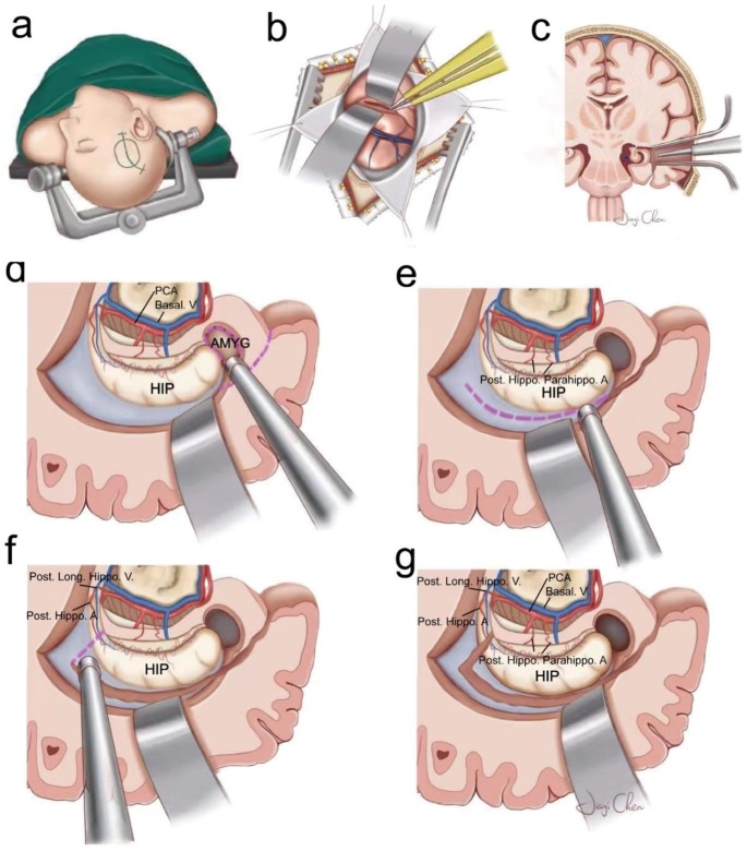 Medial temporal lobotomy in the treatment of medial temporal lobe ...