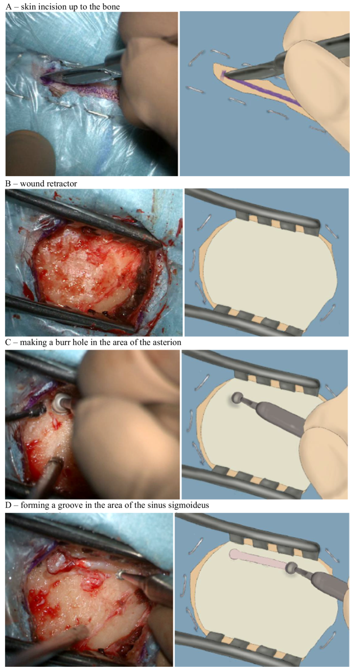 The retrosigmoid keyhole approach to the cerebellopontine angle: a ...