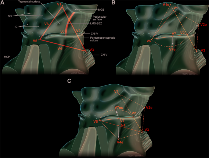Correction to: Supracerebellar-supratrochlear and supracerebellar ...