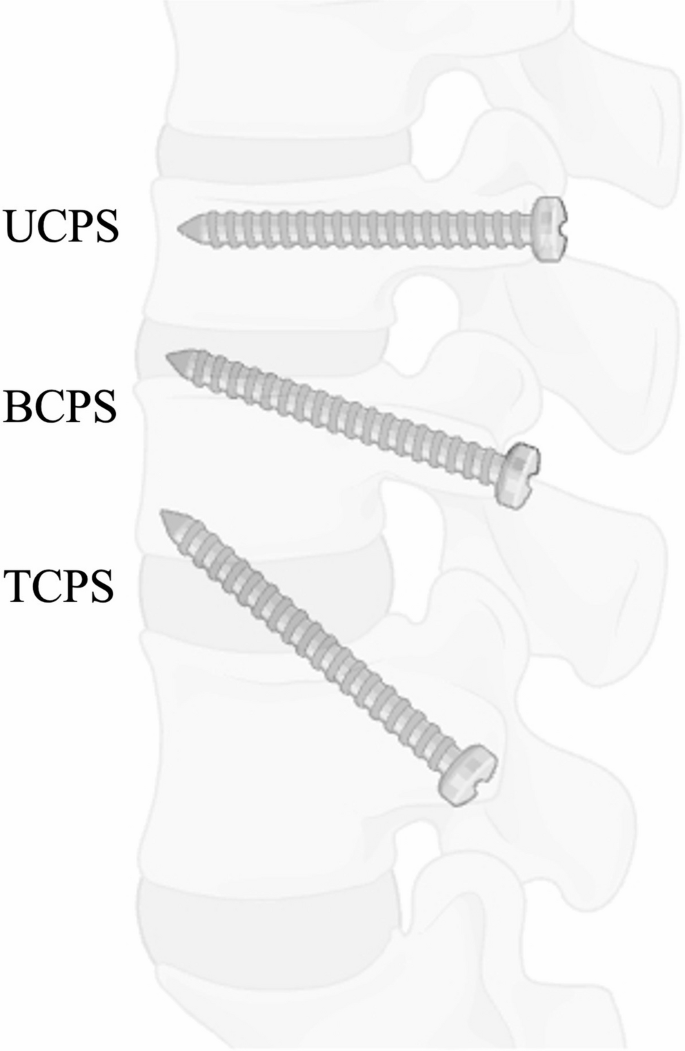 Tricortical screw spinal fixation: a scoping review and introduction of ...