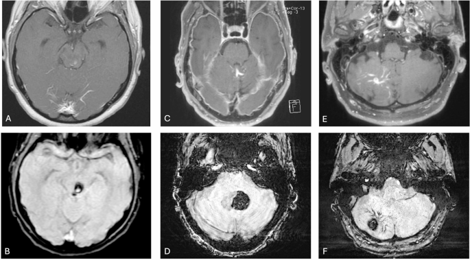 Single vs. multiple lesions in sporadic cerebral cavernous ...
