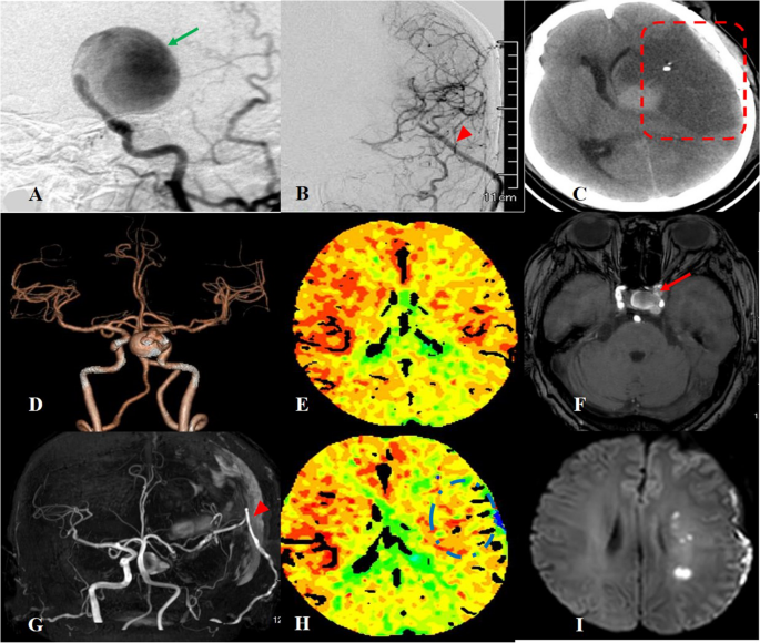 Cerebral revascularization with one-stage and two-stage aneurysm trapping for complex ...