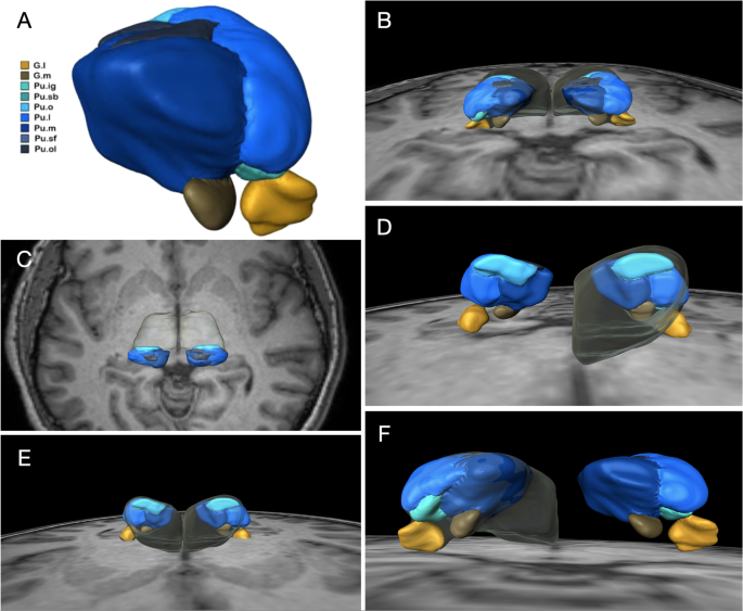 Pulvinar responsive neurostimulation for posterior quadrant epilepsy ...