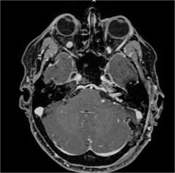 A single-centre case series of cerebellopontine angle meningioma with ...