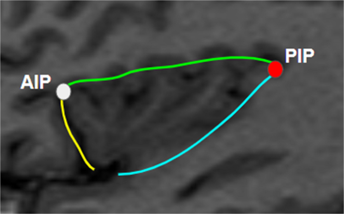 Anatomical references for the transopercular approach to the insula: a ...