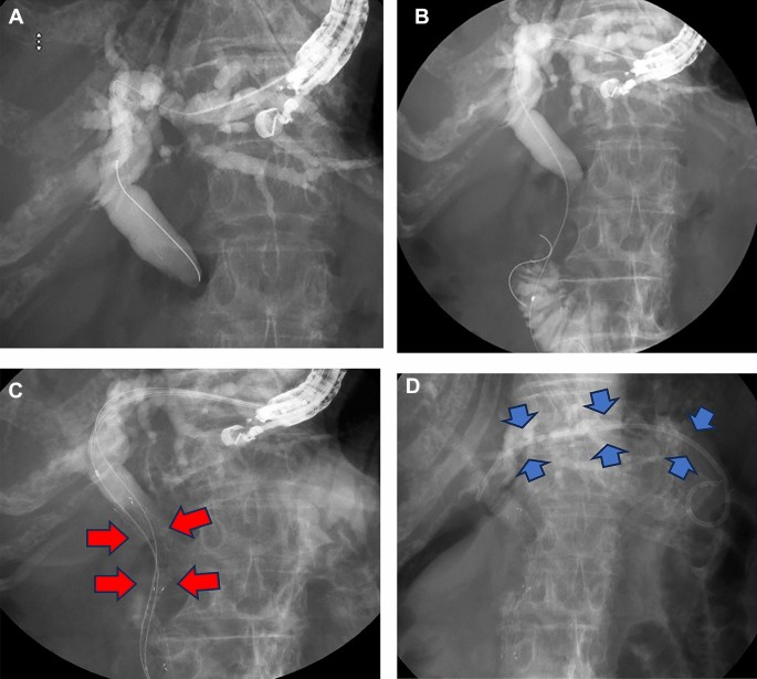 Endoscopic ultrasound-guided hepaticogastrostomy vs. antegrade metal ...