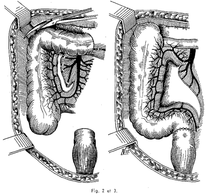 Modified Rosi–Cahill technique after left extended colectomy for ...