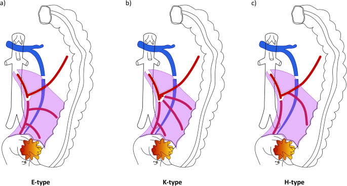 Vascular-oriented D3 lymph node dissection with left colic artery ...