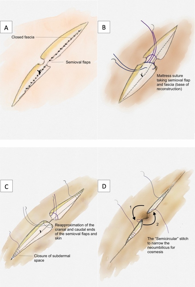 Novel technique and outcomes of umbilical reconstruction during ...