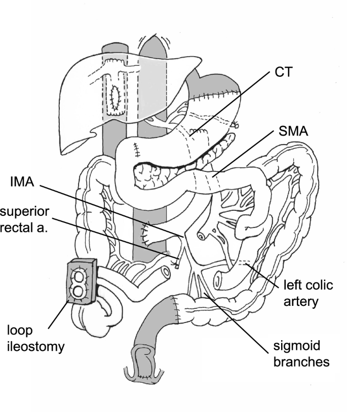 First report of full colon transplantation as part of a visceral ...