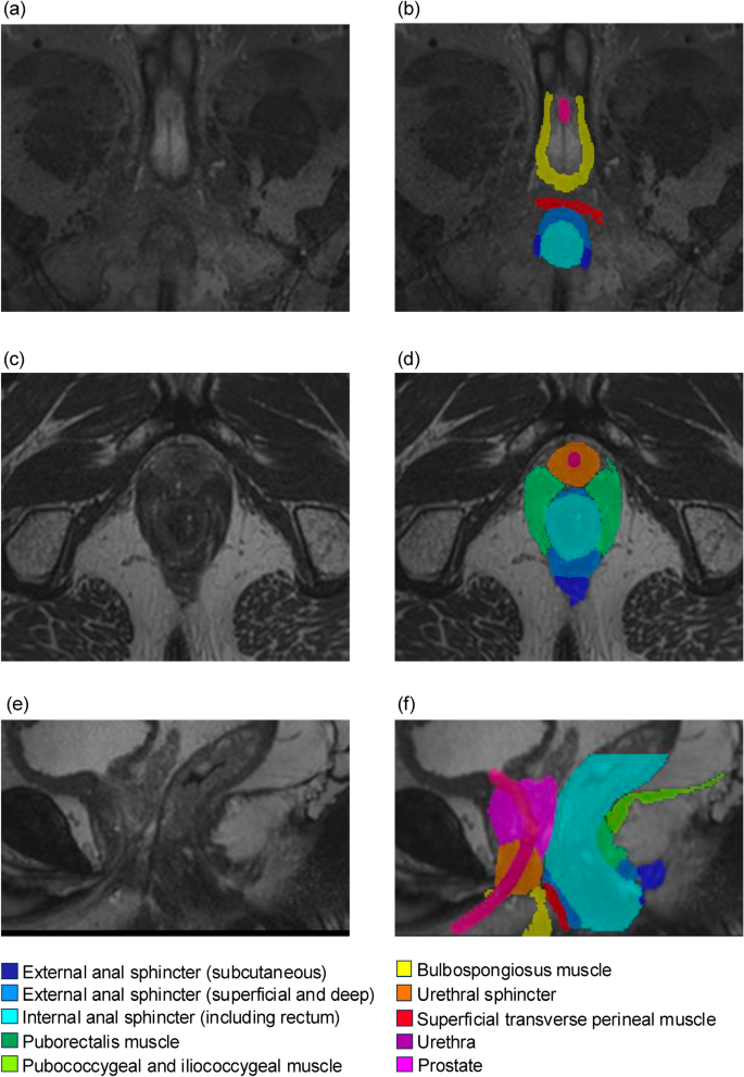 Automatic segmentation of male pelvic floor soft tissue structures for ...