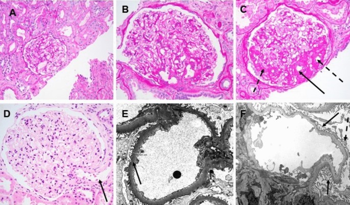 Obesity-related glomerulopathy, A growing kidney burden in the obesity ...