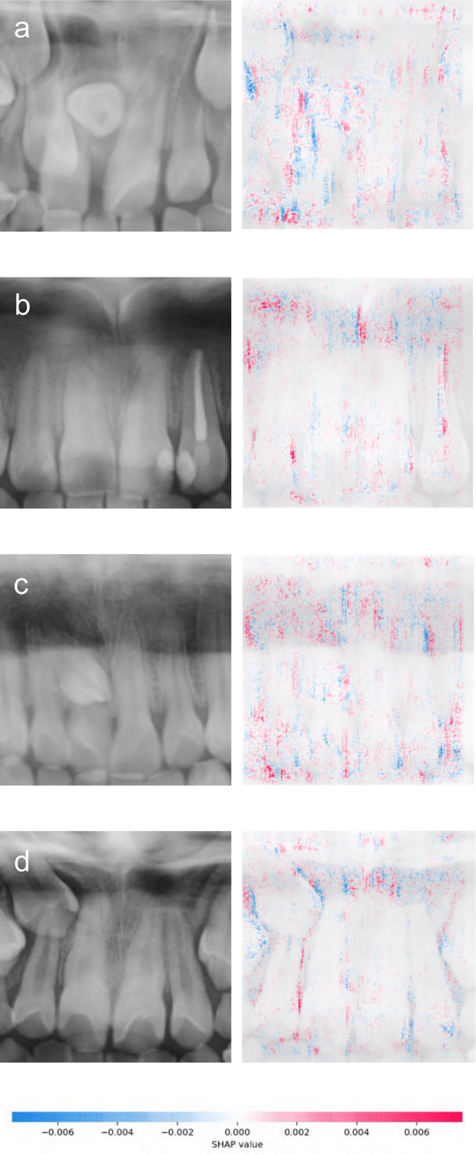 Deep learning with convolution neural network detecting mesiodens on panoramic radiographs ...