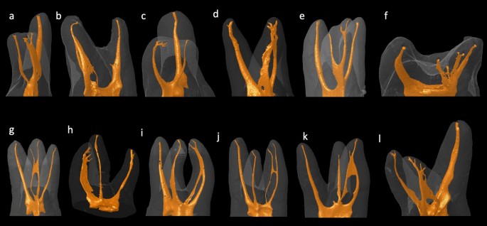 Influence of root fusion on canal orifice configuration, lateral ...