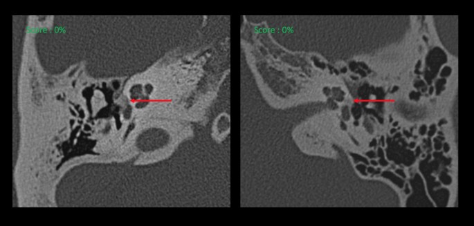 Artificial Intelligence for Otosclerosis Detection: A Pilot Study | Journal of Imaging ...