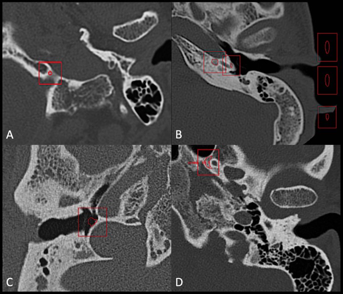 Artificial Intelligence for Otosclerosis Detection: A Pilot Study | Journal of Imaging ...