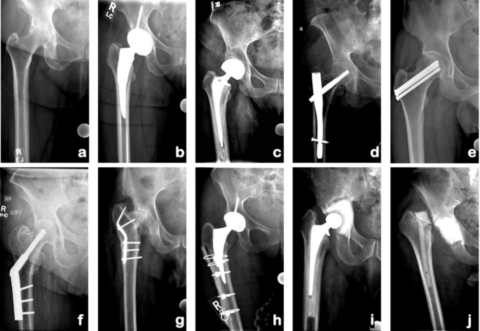 Deep Learning for Automated Classification of Hip Hardware on ...