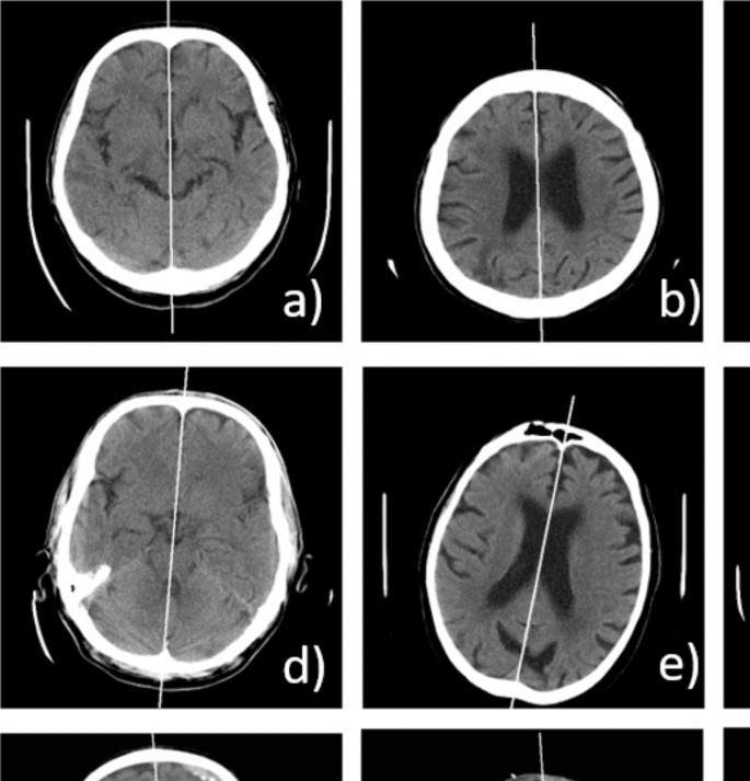 Brain Midline Approximation to Improve Symmetry Analysis of Brain CT ...