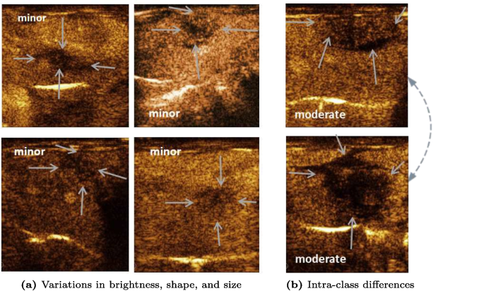 Robust Automatic Grading of Blunt Liver Trauma in Contrast-Enhanced ...