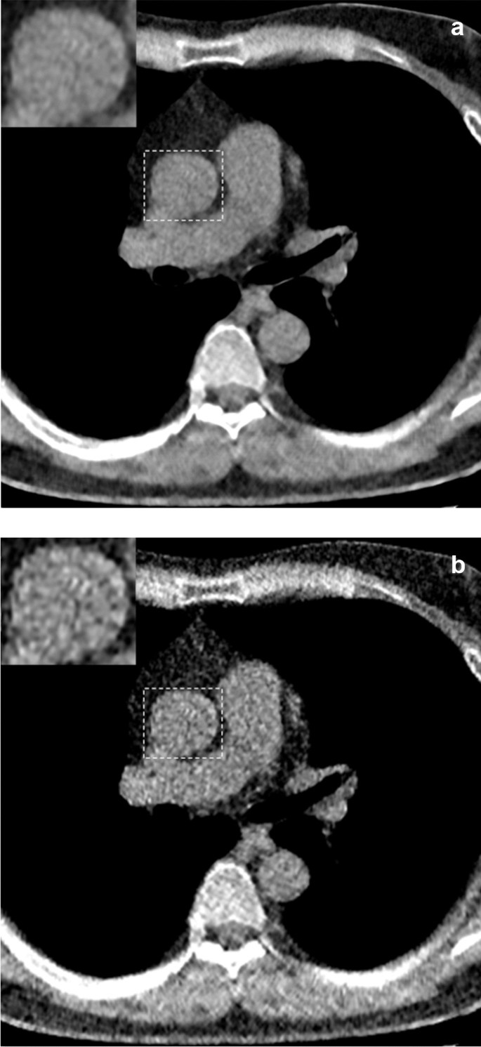 Impact of Super-Resolution Deep Learning Reconstruction on Low-Dose CT ...