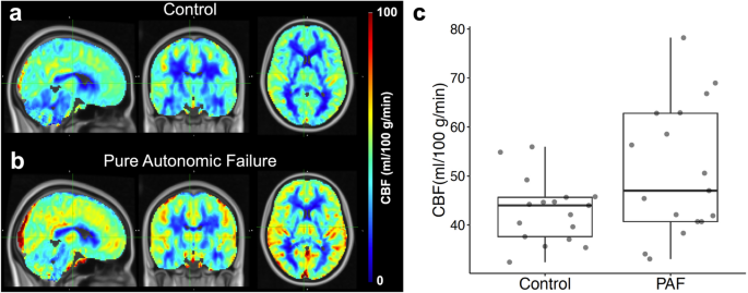 Elevated cerebral blood flow in patients with pure autonomic failure ...
