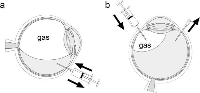 Rescue pneumatic retinopexy for recurrent retinal detachments due to ...