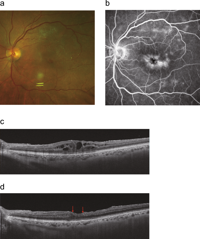Recent advances in the diagnosis and treatment of refractory ocular ...