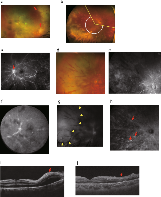 Recent advances in the diagnosis and treatment of refractory ocular ...